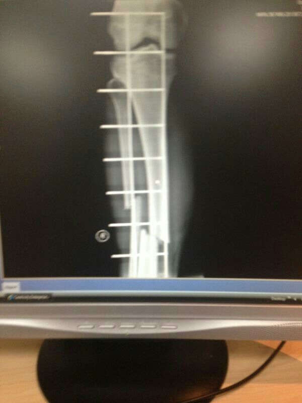 Martin Groenewald injury update – SchoolBoyRugby Blog